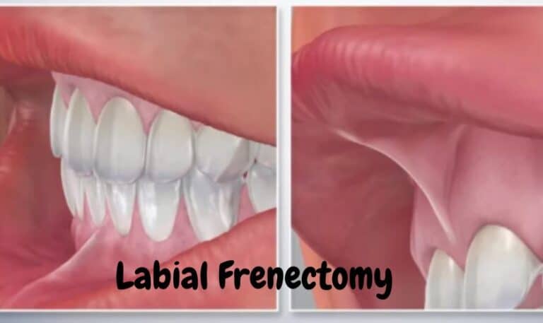 What Is A Labial Frenectomy, And What Do You Need To Know?